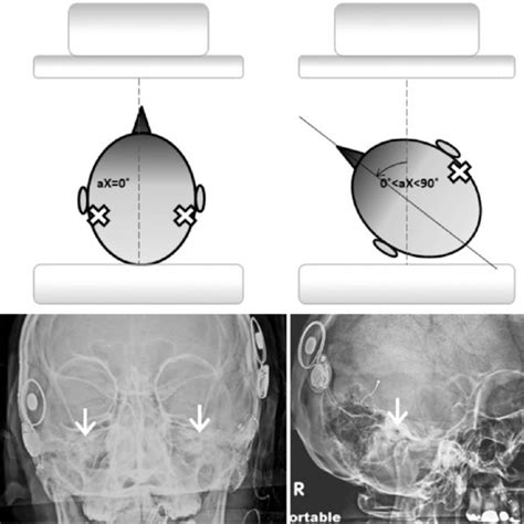Pdf Measurement Of Cochlear Implant Electrode Position From