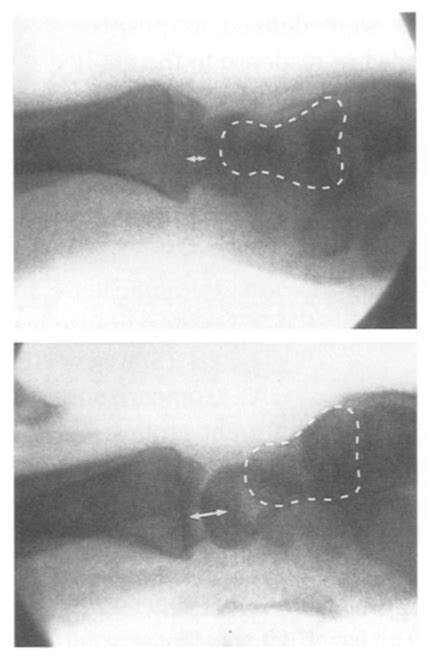 The Midcarpal Shift During The Scaphoid Shift Test The Capitate Download Scientific Diagram
