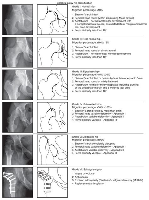 Southwick Osteotomy