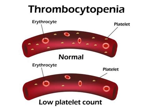 Normal Platelet Count Dengue Phil Parsons