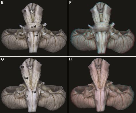 3d Simulation Of Fiber Dissection Of The Cerebellum And Brainstem The
