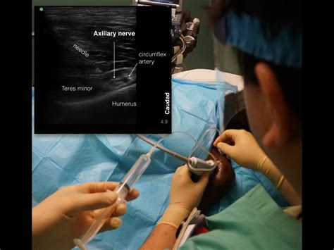 Intercostobrachial Nerve Block