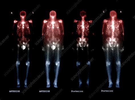 Bone Scan Of Metastatic Disease Stock Image C003 4689 Science