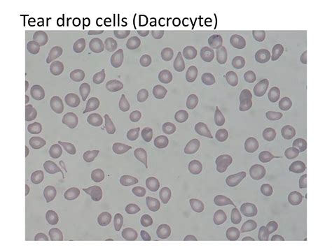 Anemia Classification Cf Lab Diagnosis Ppt