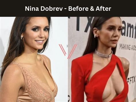 Celebrities With Breast Implants Before And After Photos Vantage Clinic Cosmetic Surgery