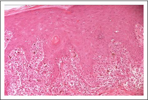 Figure 2 From Late Occurring Captopril Induced Lichenoid Eruption Semantic Scholar