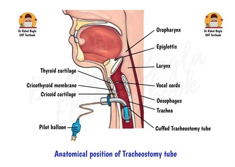 Tracheostomy Temporary Permanent And Emergency Options