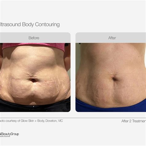 Fat Cavitation And Rf Skin Tightening Moore Beautiful