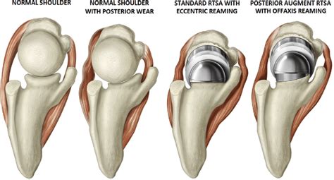 Use Of Posterior Augmented Glenoid Baseplates To Preserve Glenoid Bone