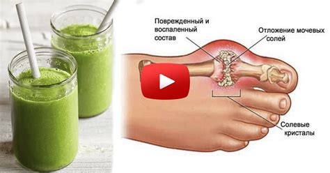 Предотврати заболевание суставов! Вкусная профилактика подагры ...