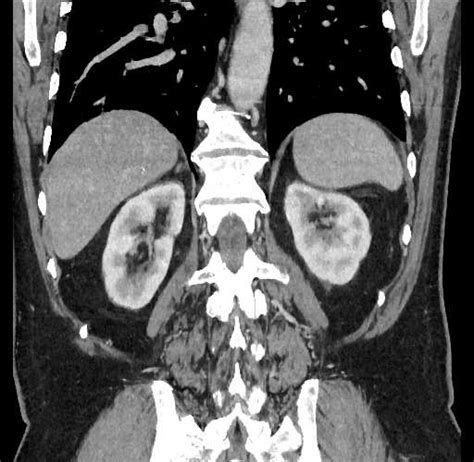 training data for 3d gm mrf model a normal dose clinical ct