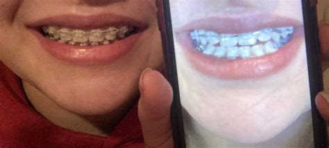 8weeks Post Op Ujs Class 3 Edge To Edge Bite Im So Happy With The