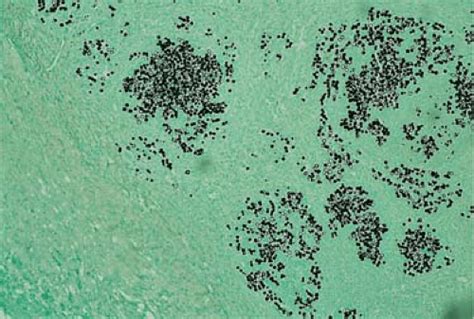 Cryptococcus Lymphadenitis Basicmedical Key