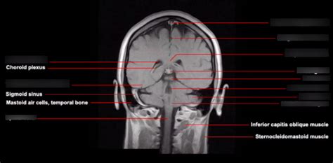 Mri Coronal Plane Of Brain Diagram Quizlet