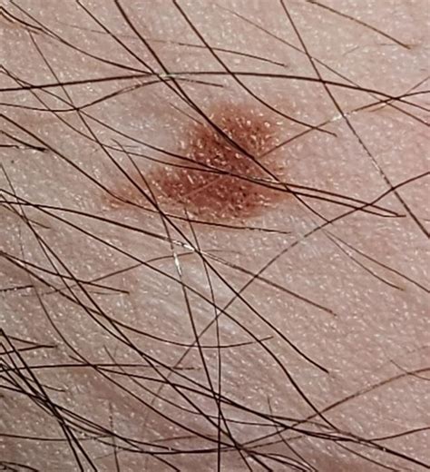 Flat Frecklesmoles Concern Rmelanoma