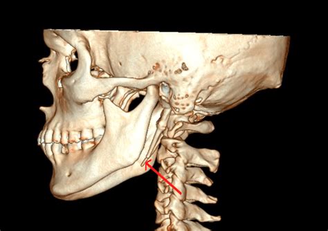 Styloid Process Neck The Sword In The Throat A Rare Case Of A 75 Cm