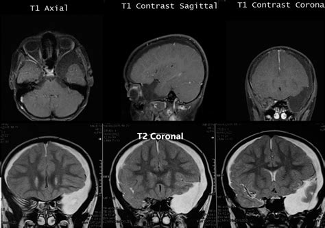 Spontaneous Rupture Of Arachnoid Cyst Journal Of Neurosciences In Rural Practice