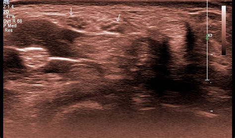 Do You Know Why It Is Important To Document The Presence Of A Bifid Median Nerve And Persistent