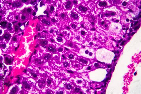 Histopathology Of Acute Hepatitis Light Micrograph Photo Under