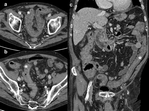 Pseudomembranous Colitis Spiral Ct Scan Obtained With Intravenous Download Scientific Diagram