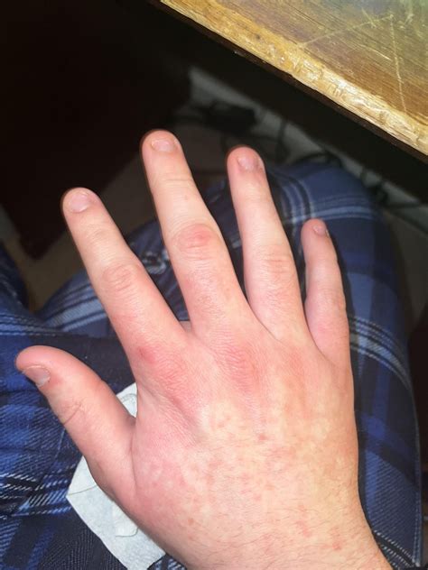 Does This Sound Like Arthritis Rthritis