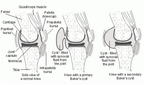 Popliteal Cyst Bakers Cyst Physiotherapy Treatment