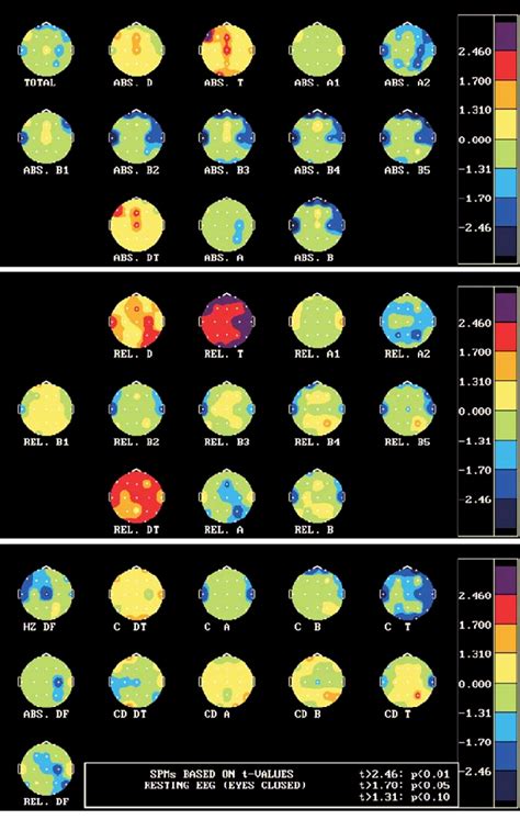 Maps Of Eeg Differences Between Narcolepsy Patients And Normal Controls Download Scientific