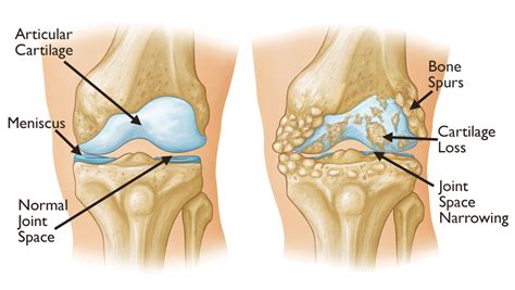 Osteoarthritis Oa Symptoms Causes And Best Treatment Options