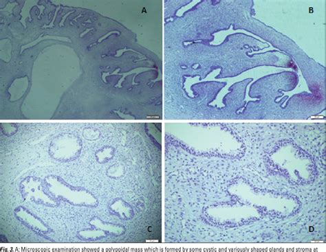 Figure 1 From Spindle Benign Phyllodes Tumour Of The Prostate An