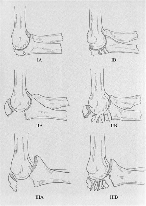 Mayo Classification Of Olecranon Fractures Download Scientific Diagram