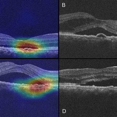 A Representative Case Of Persistent Csc With Oct Angiography The Left Download Scientific