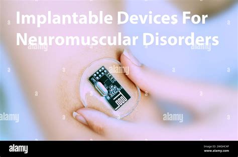 Implantable Devices For Neuromuscular Disorders Devices That Deliver Electrical Stimulation Or