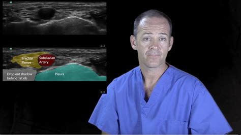 How To Perform An Ultrasound Guided Supraclavicular Nerve Block