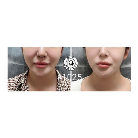Fat Decomposition Injectionboth Cheeks Of The Nose Dr K Medi Spa
