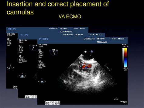 Ppt Echocardiographic Monitoring On Ecmo Powerpoint Presentation