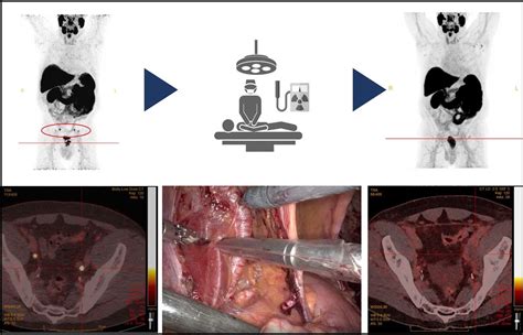 Radioguided Surgery Detects And Removes Metastatic Lymph Nodes In Newly