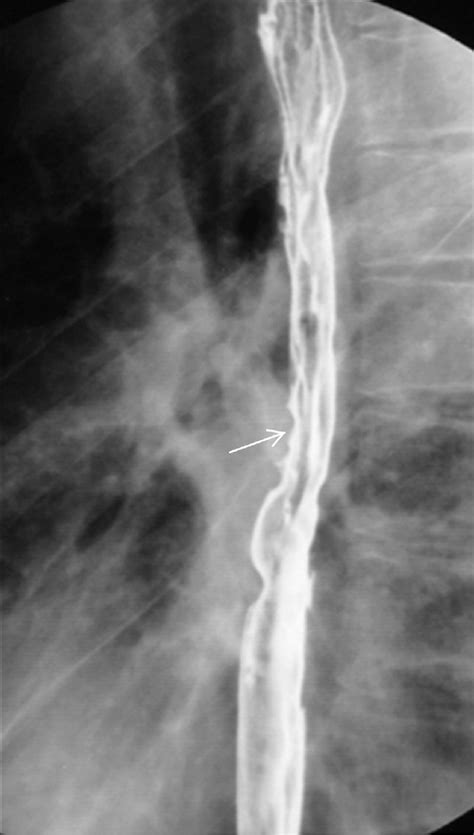 Barretts Esophagus Upright Lpo Image Of Double Contrast Barium Download Scientific Diagram