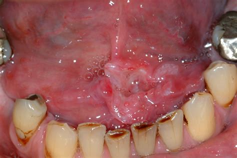 Malignant Tumor In Tongue At Annie Burress Blog