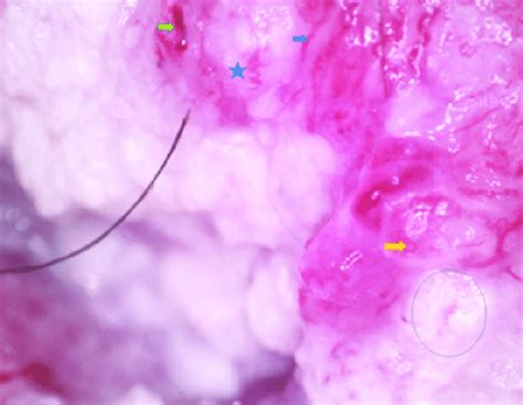 Dermoscopy Shows A White Structureless Area Blue Circle Linear Download Scientific Diagram