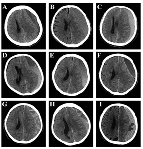The Classification Of Csdh According To The Hematoma Density On Ct Download Scientific Diagram