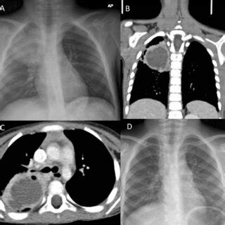 Chest X Ray CXR And Chest Computed Tomography CT Findings In Case Download Scientific