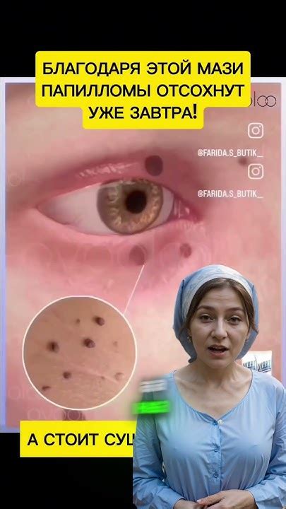 ЧУДО МАЗЬ ОТ ПАПИЛЛОМ Youtube