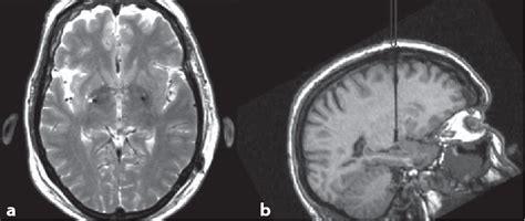 Spasmodic Croup Semantic Scholar