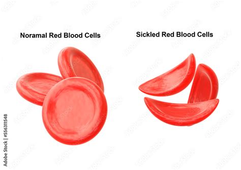 Sickle Cell Anemia Is A Hereditary Disease Characterized By The