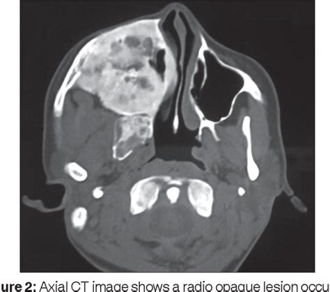 Figure 1 From Craniofacial Polyostotic Fibrous Dysplasia Semantic Scholar