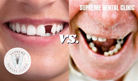 single tooth replacement vs multiple tooth replacement