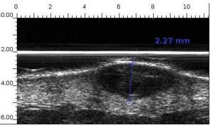 Level 1 Melanoma Ultrasound