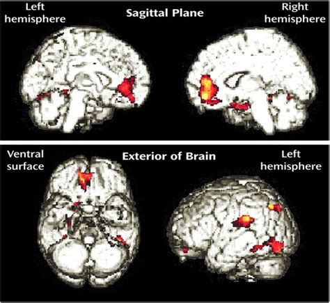 Borderline Personality Disorder Brain Vs Normal Borderline Personality Disorder Brain Vs Normal