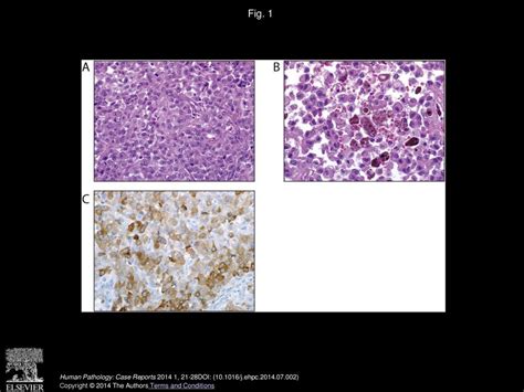 activating mutations of the oncogene ezh2 in cutaneous melanoma