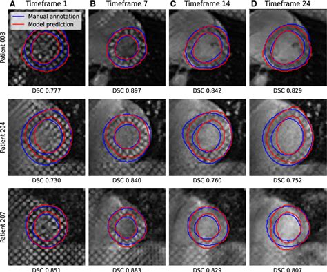Figure 10 From Myocardial Segmentation Of Tagged Magnetic Resonance
